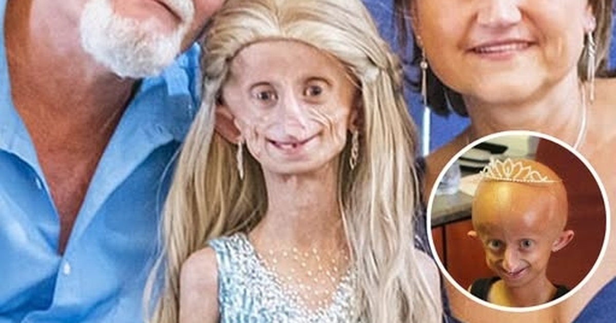 Beandri Booysen: Girl in South Africa with progeria dies - Yohanpost
