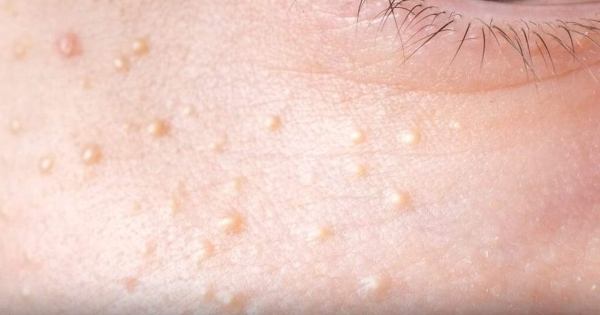 If You Have These Tiny, White Bumps on Your Face, Don’t Try to Remove ...
