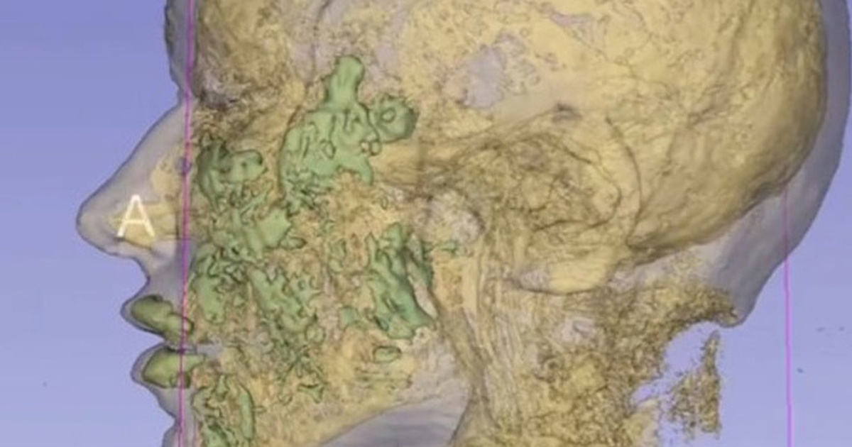 Doctor Reveals: MRI Scan Of The Face Of A 33-Year-Old Woman Reveals ...