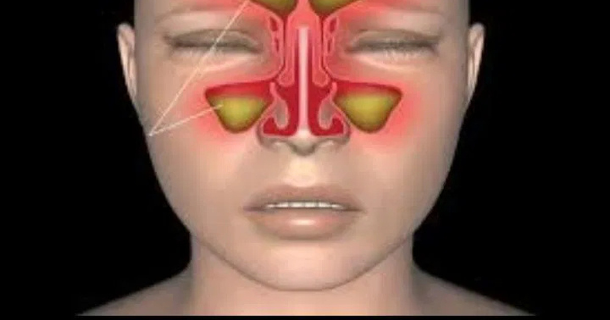 10 Natural Remedies To Help Deal With a Sinus Infection - Yohanpost