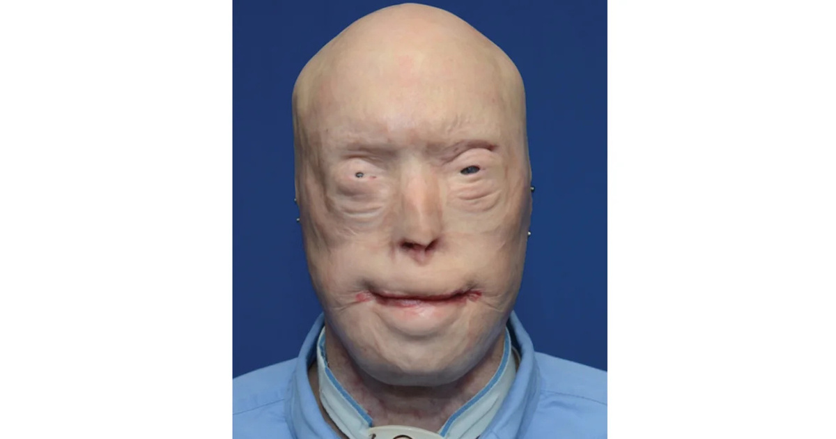 Firefighter suffers third-degree burns – this is him 7 years later ...