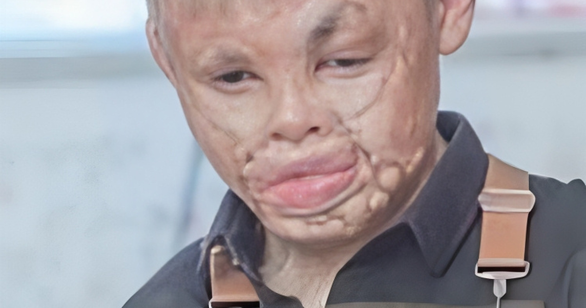 Burn survivor who didn’t leave home for 2 years now owns his own bakery ...